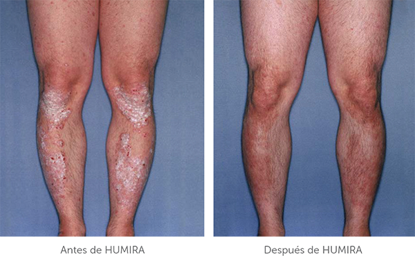 Psoriasis en Placas Crónica | Humira Puerto Rico